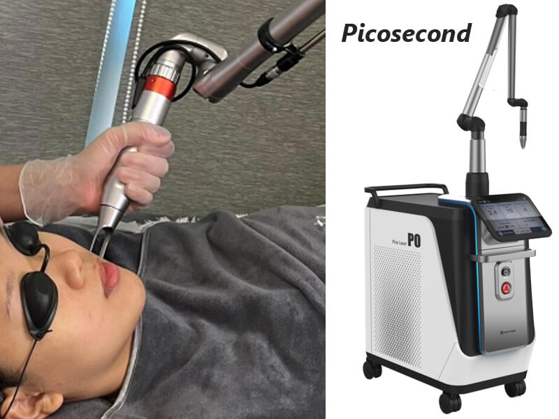 Frequently Asked and Questions about Picosecond Laser. China Picosecond ND YAG Laser Machine Bestview Laser Bestview Laser